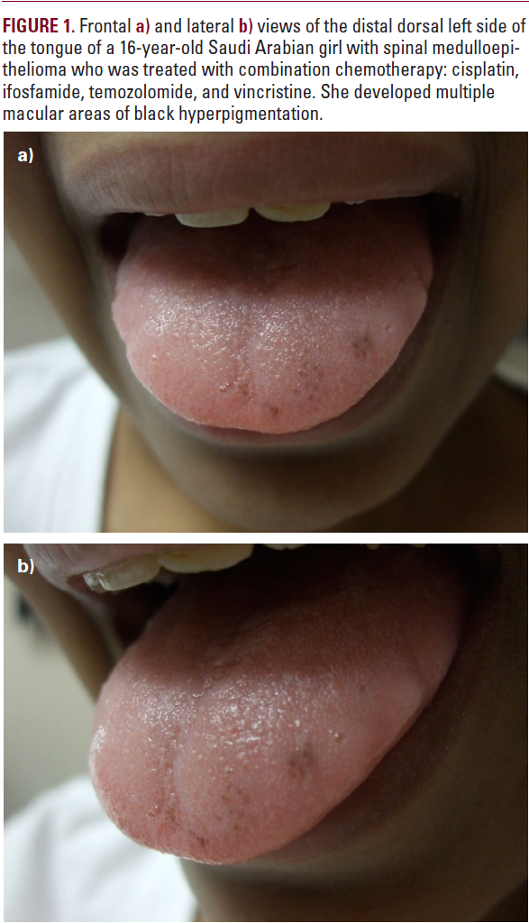 Chemotherapy Associated Tongue Hyperpigmentation And Blue Lunula 