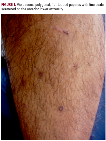 A Case of Lichen Planus Following Tdap Vaccination - JDDonline ...