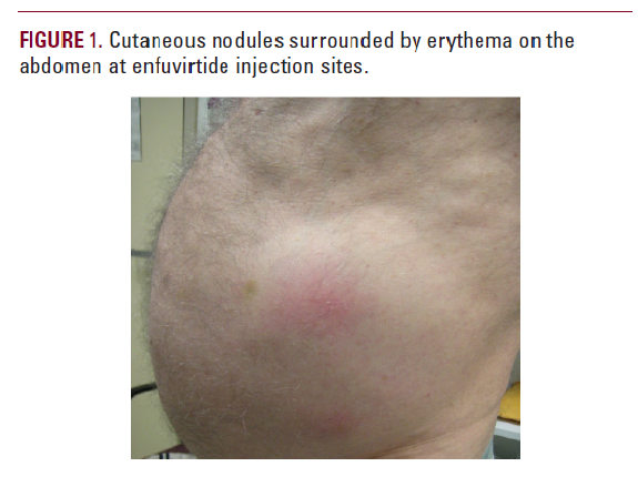 Enfuvirtide and Cutaneous Injection-Site Reactions - JDDonline ...