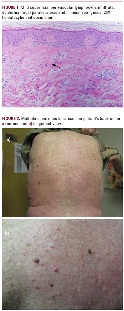 Sign and Pseudo-Sign of Leser-Trélat: Case Reports and a Review of the ...