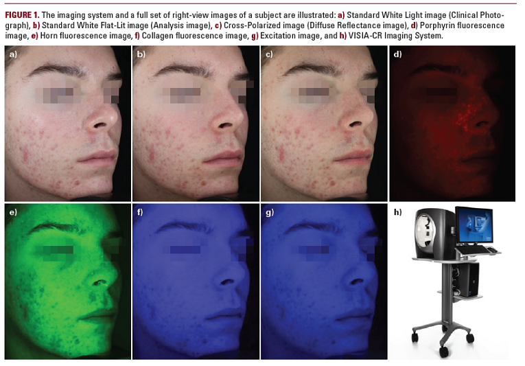 Auto-Classification of Acne Lesions Using Multimodal Imaging ...