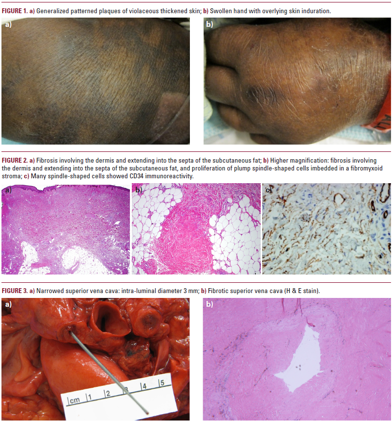 Superior Vena Cava Obstruction Associated With Nephrogenic Systemic ...