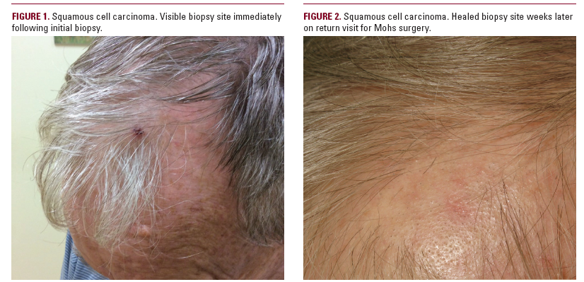 Anesthetic Blister Induction to Identify Biopsy Site Prior to Mohs ...