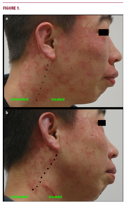 A Split-Face Study of Dual-Wavelength Laser on Neck and Facial Port ...